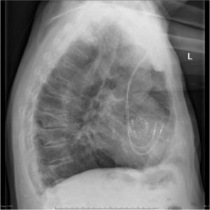 TAVI radiopedia 2 - INTENSIVE