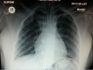 CVC placement - INTENSIVE