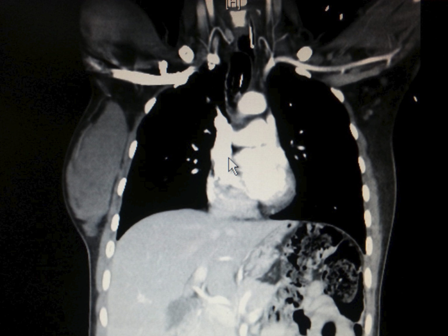 Misplaced central line, or is it? - INTENSIVE