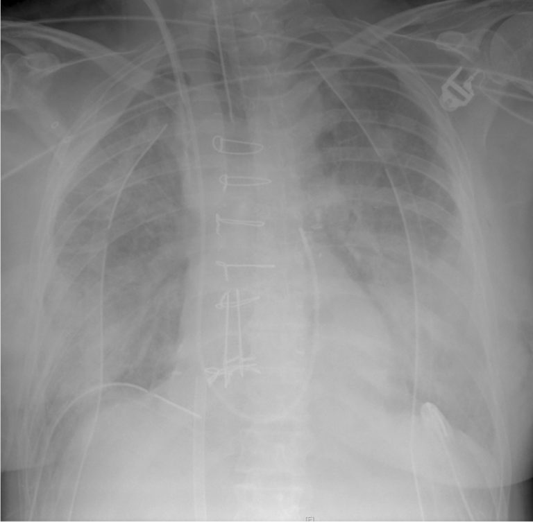 ECMO PGD BLSLTX CXR - INTENSIVE