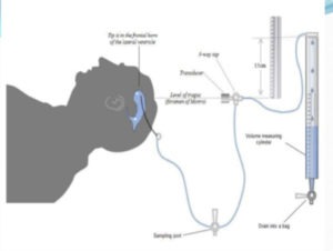 external ventricular drain Archives - INTENSIVE