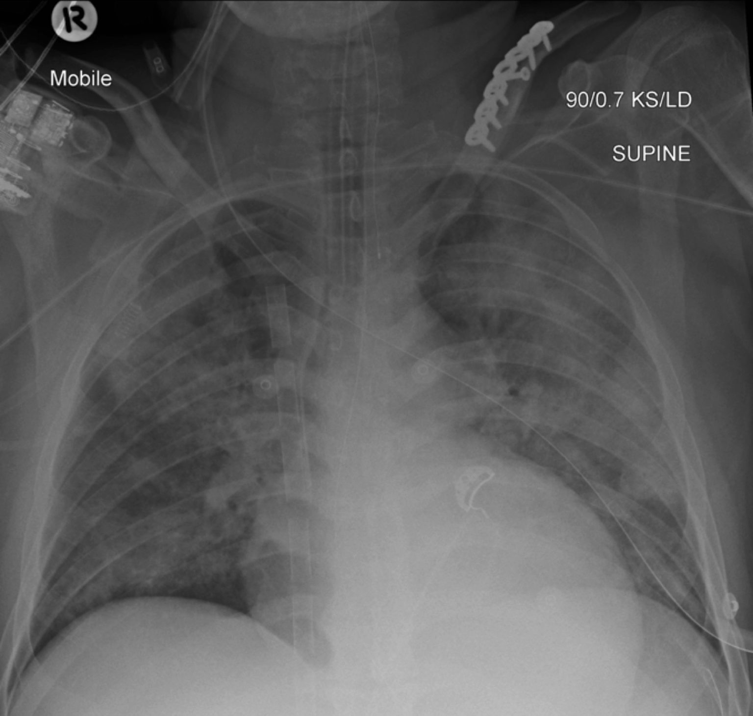 "Pink fluid coming up the tube".. ECMO, LV distention, and more ...
