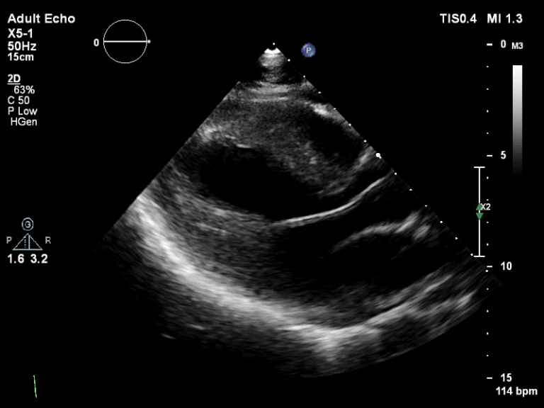 EE 020 Echo 3 PLAX pigtail - INTENSIVE