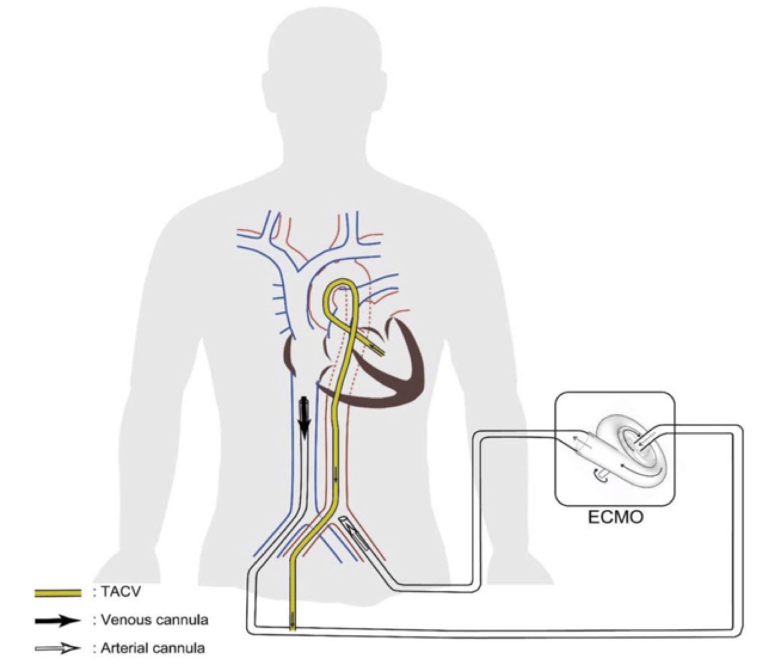 EE 020 LV vent in ECMO circuit diagram - INTENSIVE