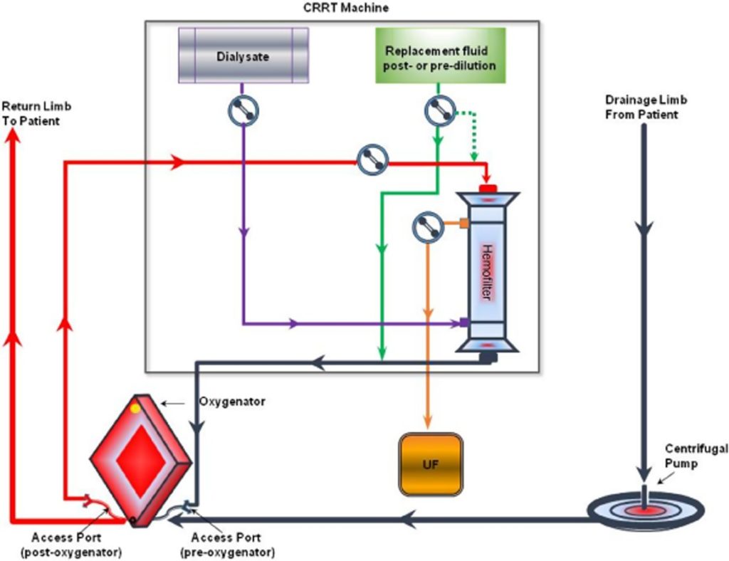 ECMO RRT HLS circuit diagram - INTENSIVE