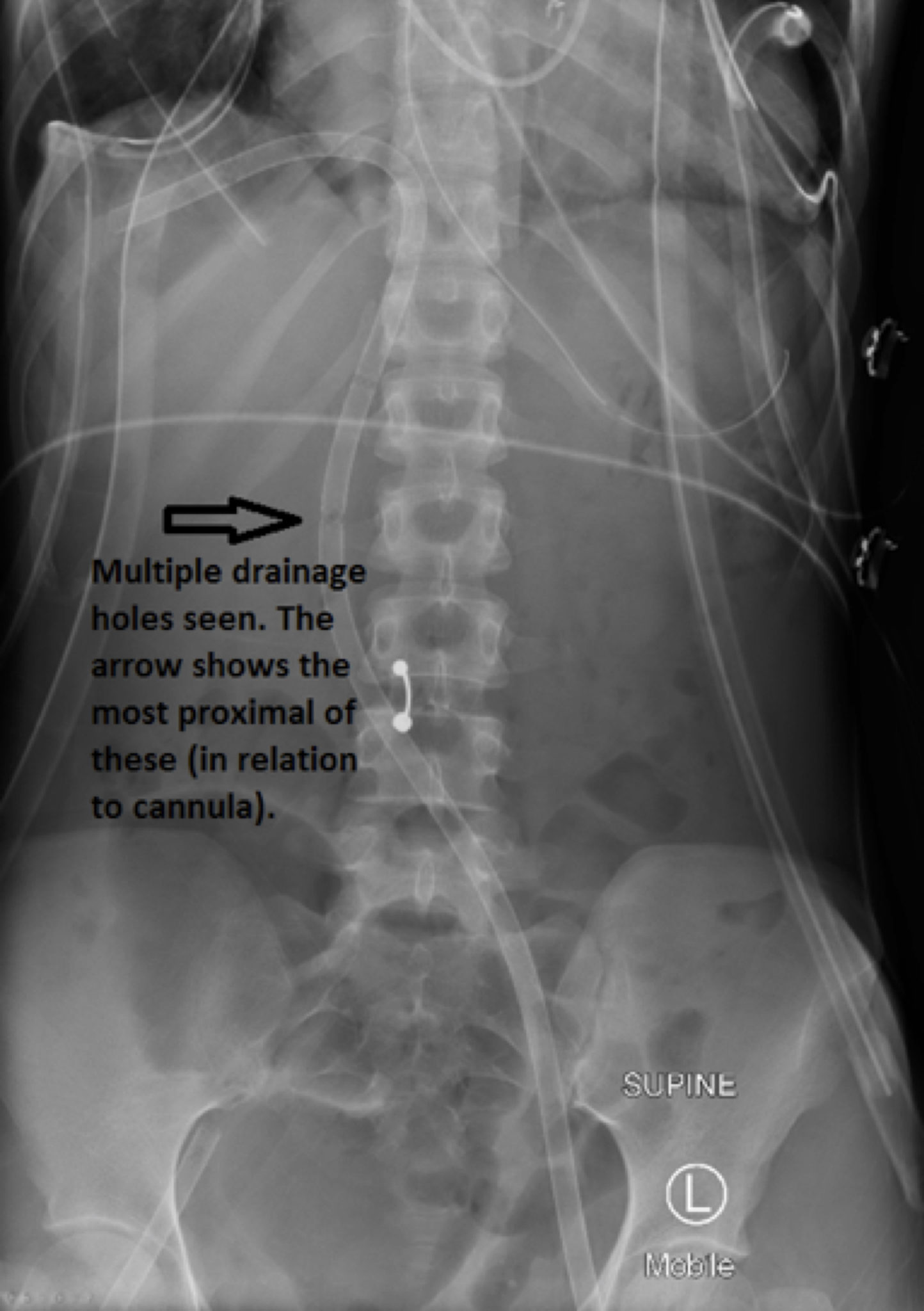 Everything ECMO: Cannula and Cardiac Curveballs - INTENSIVE