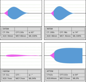ROTEM hyperfibrinolysis - INTENSIVE