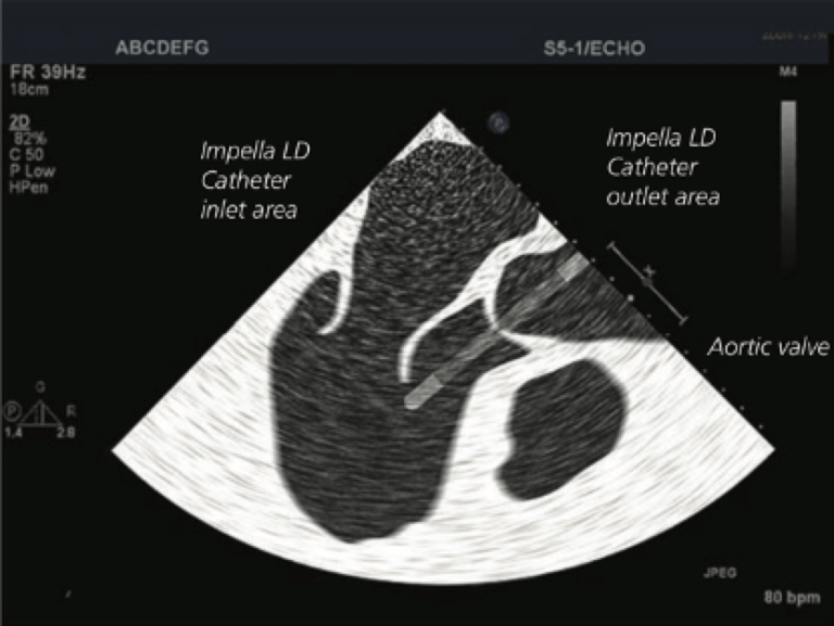 Understanding the Impella ella ella eh eh eh…… Part I! - INTENSIVE