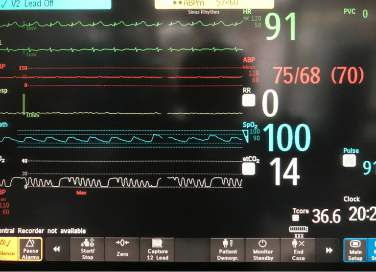 ECMO but no pulse? - INTENSIVE