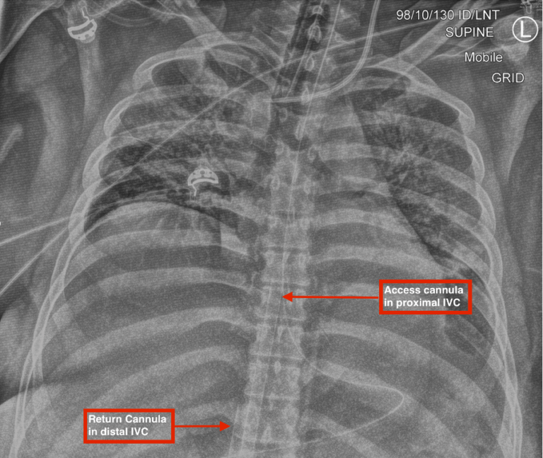 What to do when the SpO2 still stays low on VV-ECMO? - INTENSIVE