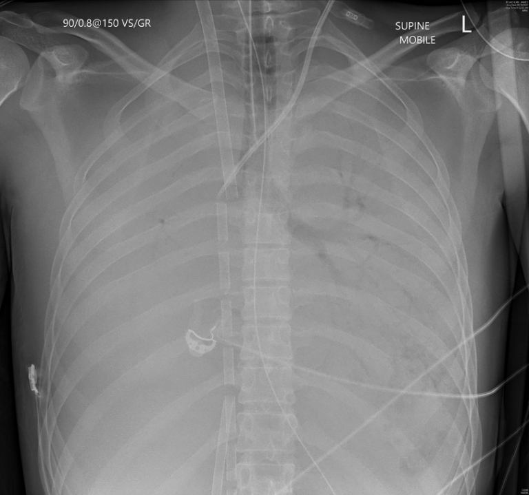 What to do when the SpO2 stays low on VV-ECMO? - INTENSIVE